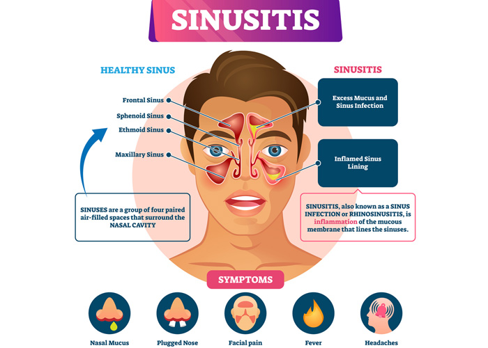 Understanding the Difference between Sinusitis and Rhinitis - Ear Nose ...
